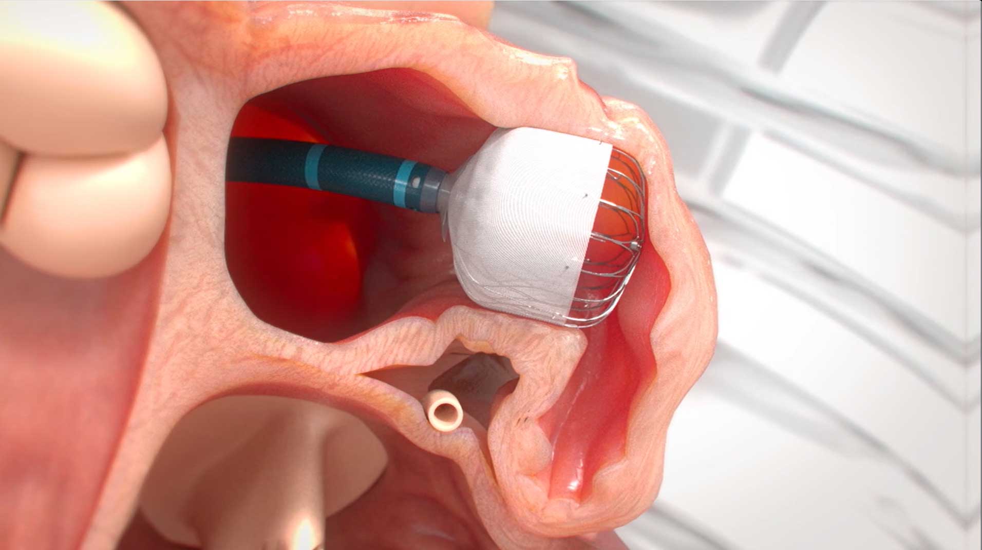 WATCHMAN FLX Pro Device