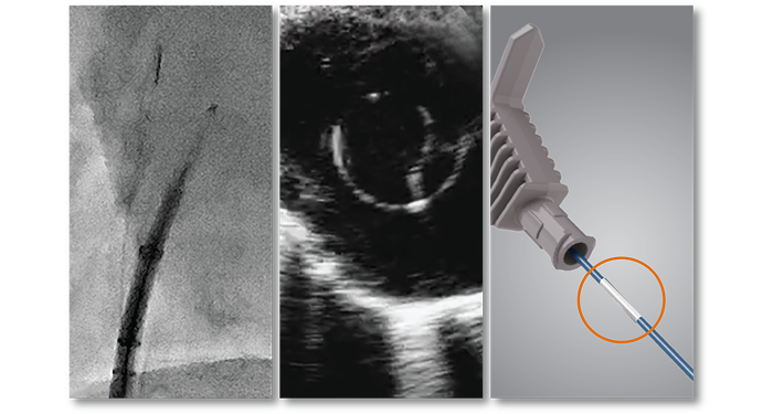 VersaCross Connect LAAC Access Solution - WATCHMAN FLX