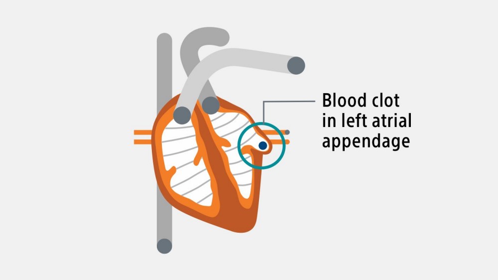 WATCHMAN Implant - Reduce AFib-related Stroke Risk - Get AFib Facts