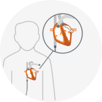 WATCHMAN Implant - Minimally Invasive, One-time Implant Procedure
