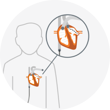 WATCHMAN Implant - Articles - Get to know the WATCHMAN Implant ...