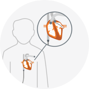 WATCHMAN Implant - Articles - Get to know the WATCHMAN Implant ...