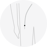 WATCHMAN Implant - Articles - Get to know the WATCHMAN Implant ...